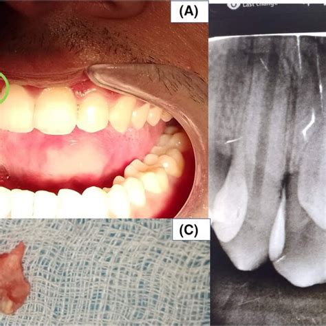 A Diffuse White Mass Protruding From The Maxillary Gingiva Adjacent Download Scientific