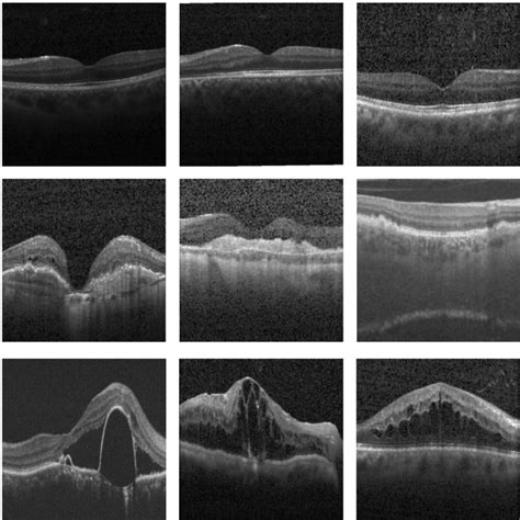 논문 리뷰 Wavenet Sf A Hybrid Network For Retinal Disease Detection Based On Wavelet Transform In