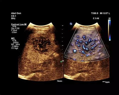 General Imaging Ultrasound Philips