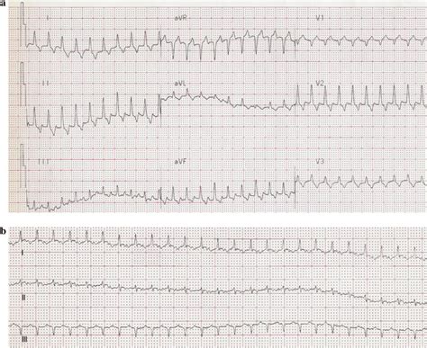 Wide Complex Tachycardia Associated With Severe Hyperkalemia In Three Cats Pmc