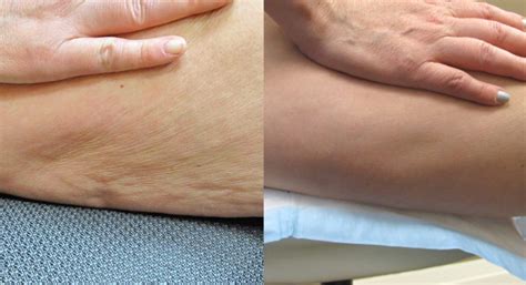 Cellulite Treatment Before And After Of Actual Dm Patients