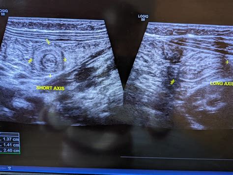 Intussusception R Radiology
