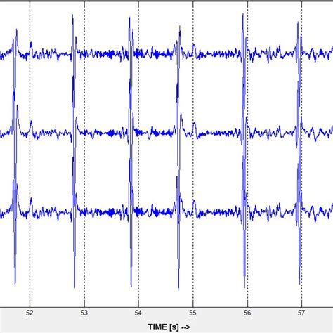 Pdf Processing Holter Ecg Signal Corrupted With Noise Using Ica For