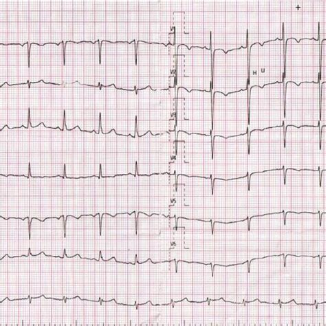 Electrocardiogram Showing Right Axis Deviation Inversion Of All