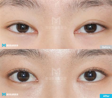 앞트임복원비용 앞트임재수술 횟수에 차이가 있을까 네이버 블로그