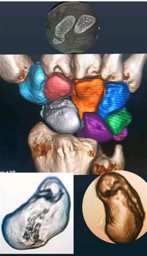 Ct Wrist Scaphoid Fracture Atef Genady