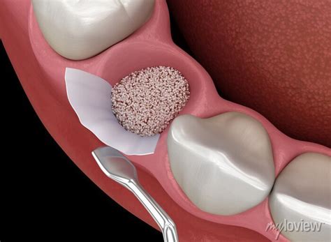 Augmentation Surgery Adding Bone After Tooth Extraction 3d Posters