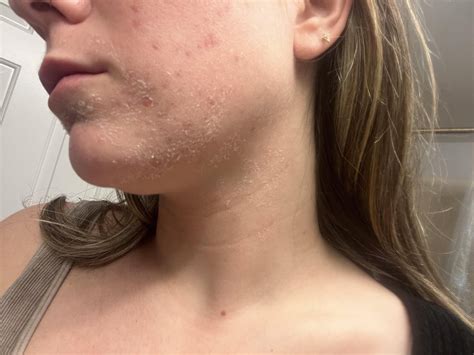 [selfie] Diagnosed With Rosacea R Skincareaddiction