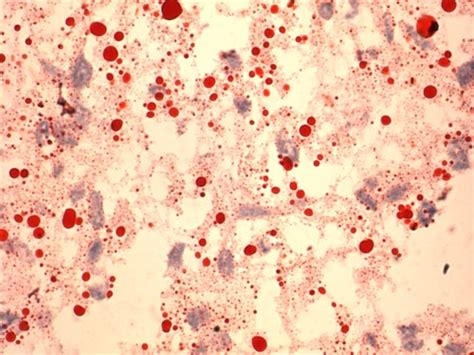 Pathology Outlines Case Of The Week 38