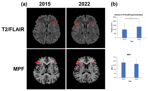 Biomedicines Free Full Text Age Related Decline In Brain Myelination Quantitative