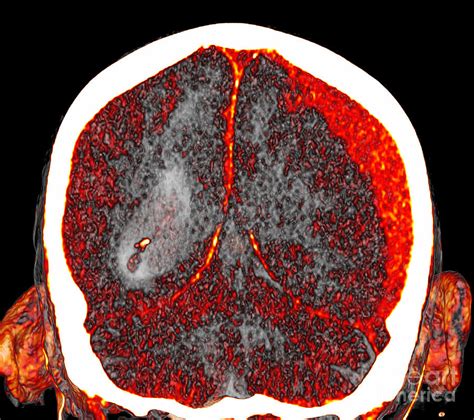 Subdural Haemorrhage 2 By Vsevolod Zviryk Science Photo Library