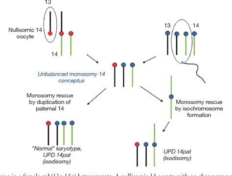 Robertsonian Translocation Karyotype