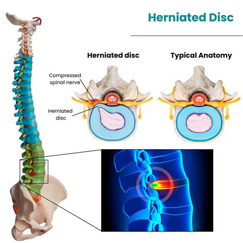 Herniated Disc Mri Or Xray