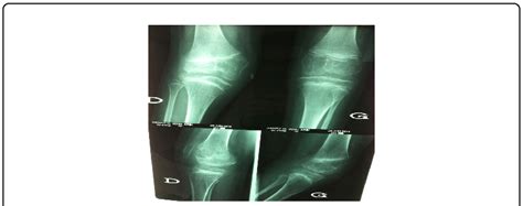 X Rays Showing Diffuse Demineralization With Knee Download