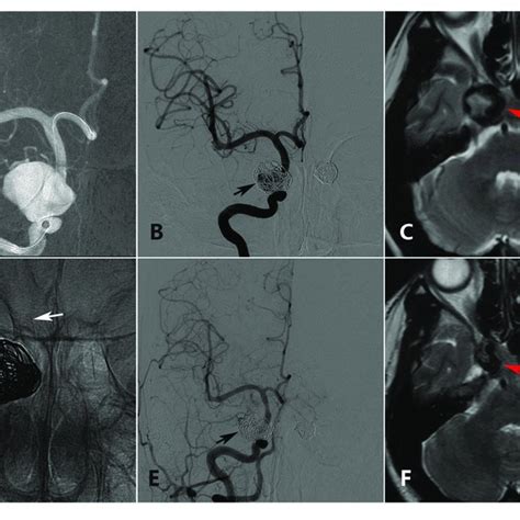A 28 Year Old Woman With A Double Cavernous Segment Ica Aneurysm The Download Scientific