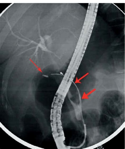 Post Laparoscopic Cholecystectomy Endoscopic Retrograde Download Scientific Diagram