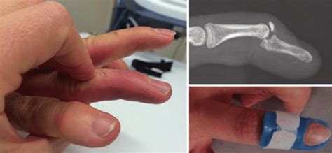35 Clinical Presentation Of An Extensor Tendon Avulsion At The Dip Download Scientific Diagram