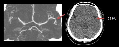 Dot Sign In Acute Stroke Stroke Manual