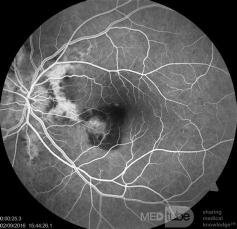 Choroidal Neovascularisation In A Patient With Angioid Atreaks Fluorescein Angiography • Image