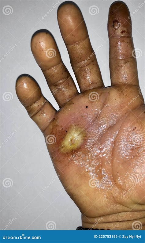 Abscess With Surrounding Cellulitis Or Staphylococcal Streptococcal