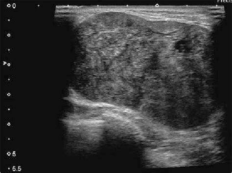Figure 1 From A Case Of Borderline Phyllodes Tumor Of The Breast That