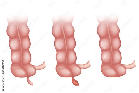 Appendicitis Is An Inflammation Of The Appendix Is An Inflammation Of