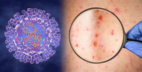 ჯანმომ საგანგებო შეხვედრა გამართა ევროპაში “მაიმუნის ყვავილის“ 100 ზე მეტი შემთხვევაა