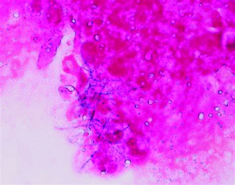 Gram Staining Of The Secretion From The Cavity Shows Gram Positive Rods