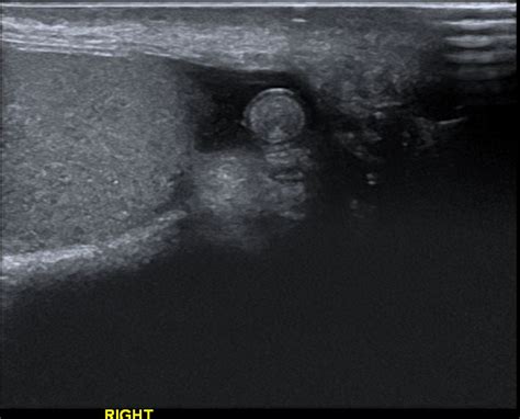 An Extratesticular Intrascrotal Right Epidermoid Cyst Sonohive
