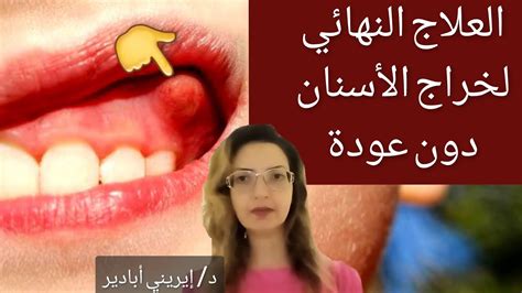 كيفية علاج خراج الأسنان و الضروس نهائياً دون عودة Youtube