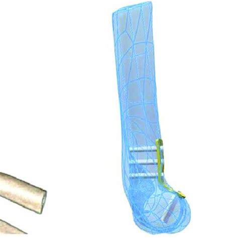 3d Reconstruction Model And Internal Fixation Method Download Scientific Diagram