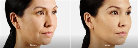 Saggy Cheeks And Jowls Treatment In Lexington Ky Bemedispa