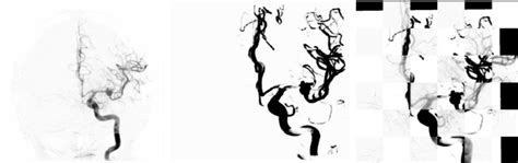 1a A 2d Max Image Produced From A 2d Dsa Image 1b A Mip Of The Download Scientific Diagram