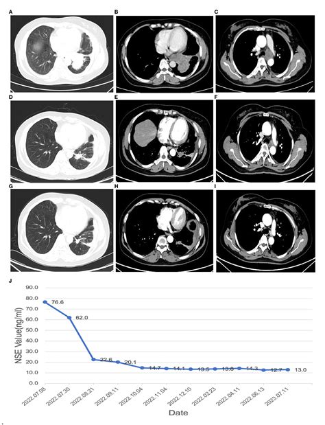 Figure 1 From Pathological Complete Response To Neoadjuvant Therapy