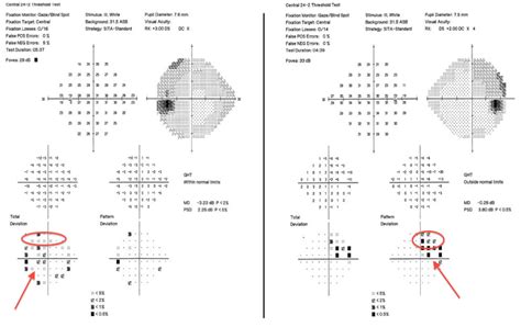 Quadrantanopia Visual Field Defect