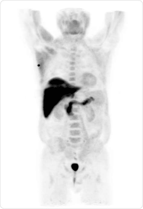 Pylarify® Case Studies Pylarify®