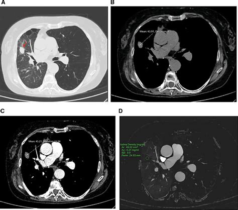 Axial Lung Window A And Soft Tissue B Conventional Ct Images Download Scientific Diagram