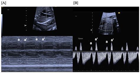 Diagnosis And Management Of Fetal Arrhythmias In The Current Era