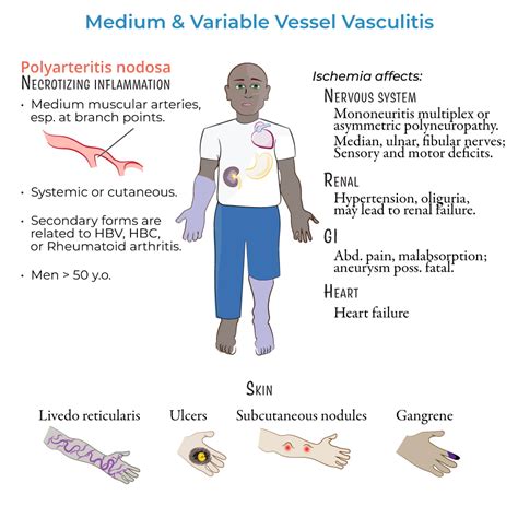 Clinical Pathology Glossary Vasculitis Medium And Variable Vessel