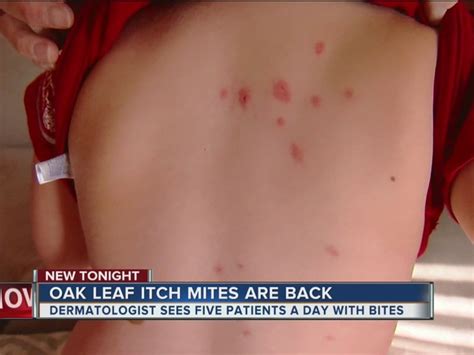 Oak Leaf Itch Mites Back For Annual Visit