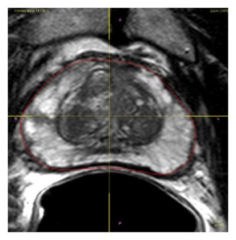 A Axial View Mri Of Prostate B Mri Overlay On Axial Trus C