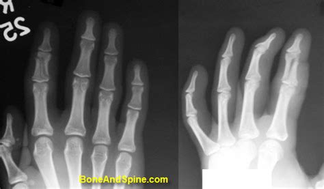 Phalanx Fractures Of Hand Types Diagnosis And Treatment Bone And Spine