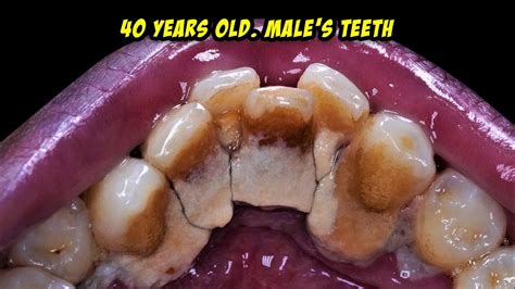 Scaling Tartar Dentist Dokter Gigi Tri Putra Youtube