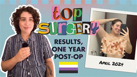 Nonbinary Top Surgery One Year Post Op No Nips Youtube