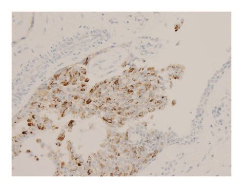 A The Tumor Cells Show A Solid Papillary Growth Pattern He Stain