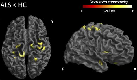 Functional Connectivity Of The Primary Motor Cortex Is Reduced In Download Scientific Diagram