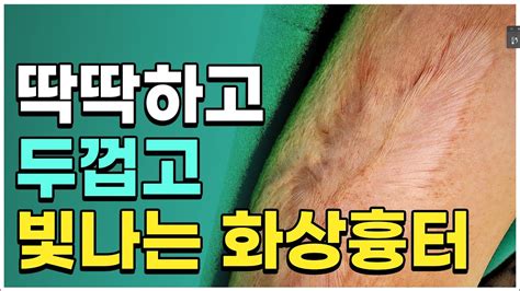 아주 어렸을 때 화상을 입은 25년전 화상흉터 Youtube