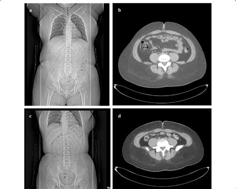 Computed Tomography Images A Overall Image Before Surgery Showing B A
