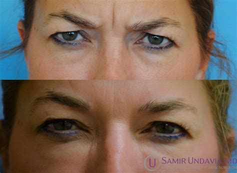 Botox Glabella Botox Fillers Botox Botox Injections