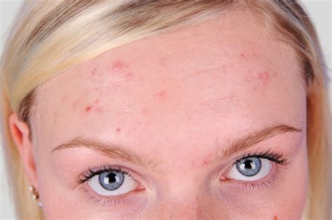 Arti Jerawat Di Dahi Tanda Kamu Lagi Stres Dan Capek Kok Bisa Stylo